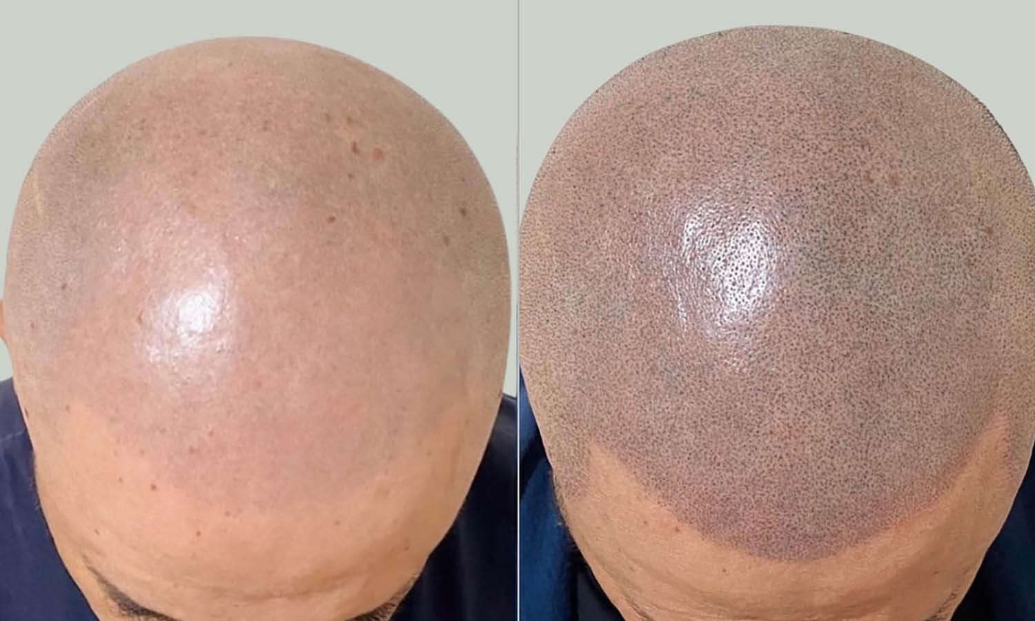 30 Best Hairlines Tattoo Ideas You Should Check